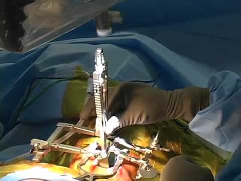 [Part 2 of 2] Synthes Spine ProDisc-C Cervical Total Disc Replacement ...