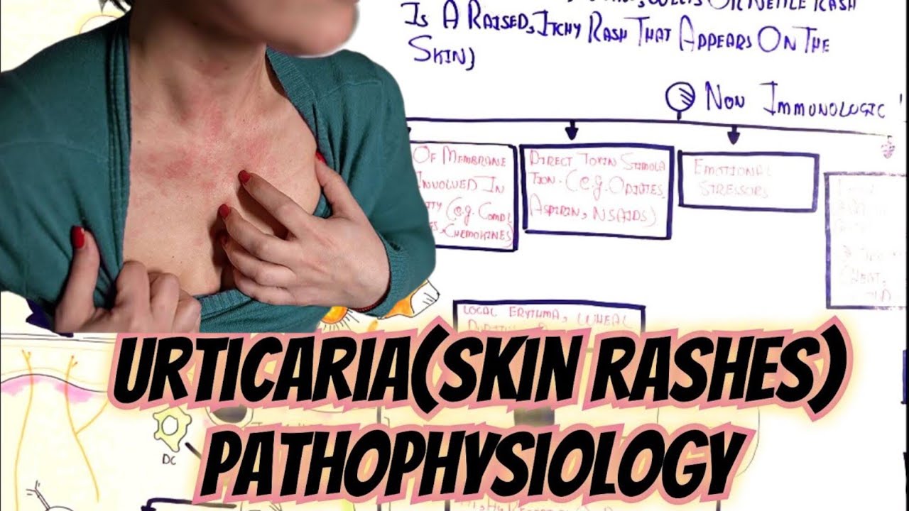 Urticaria(Skin Rashes)Pathophysiology @umerfarooqbiology7083 - YouTube