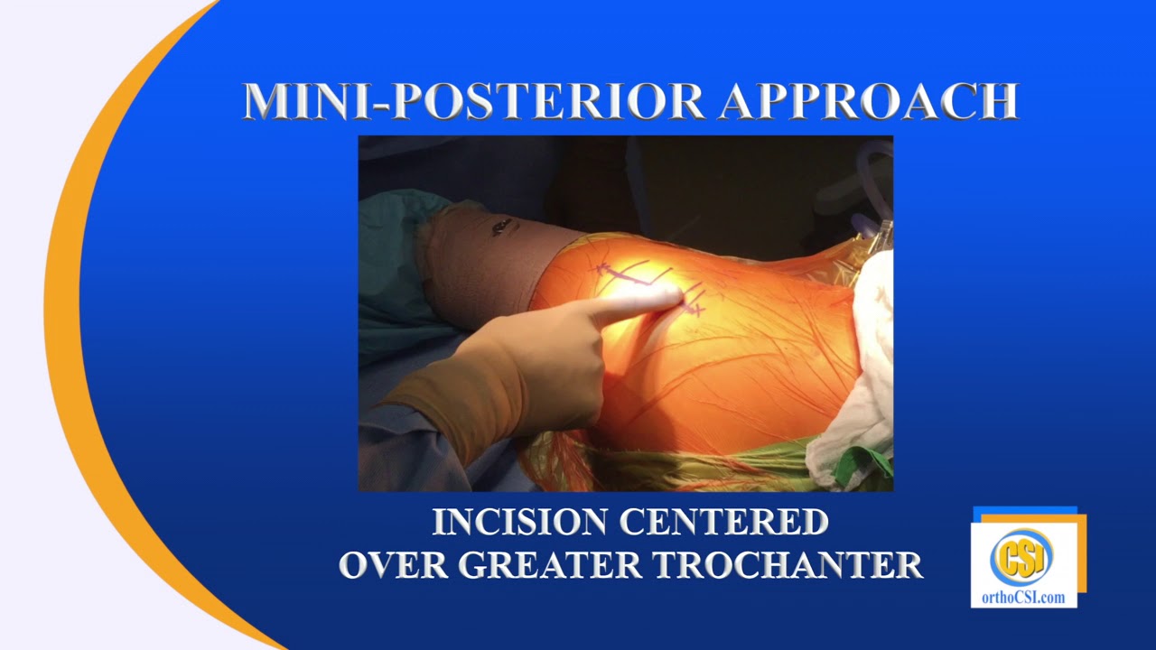 MINIMALLY INVASIVE HIP SURGERY (MIS) - YouTube