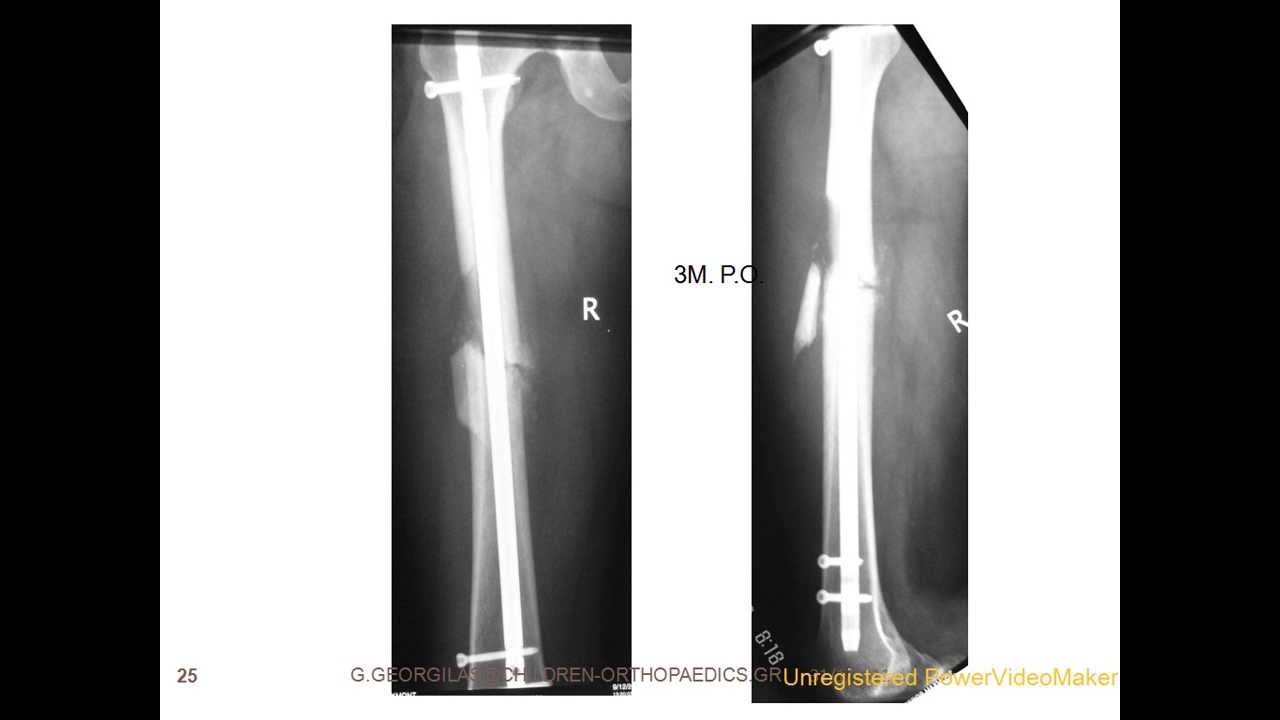 ΚΑΤΑΓΜΑ ΜΗΡΙΑΙΟΥ 2010 FEMUR FRACTURE, FEROZ - YouTube