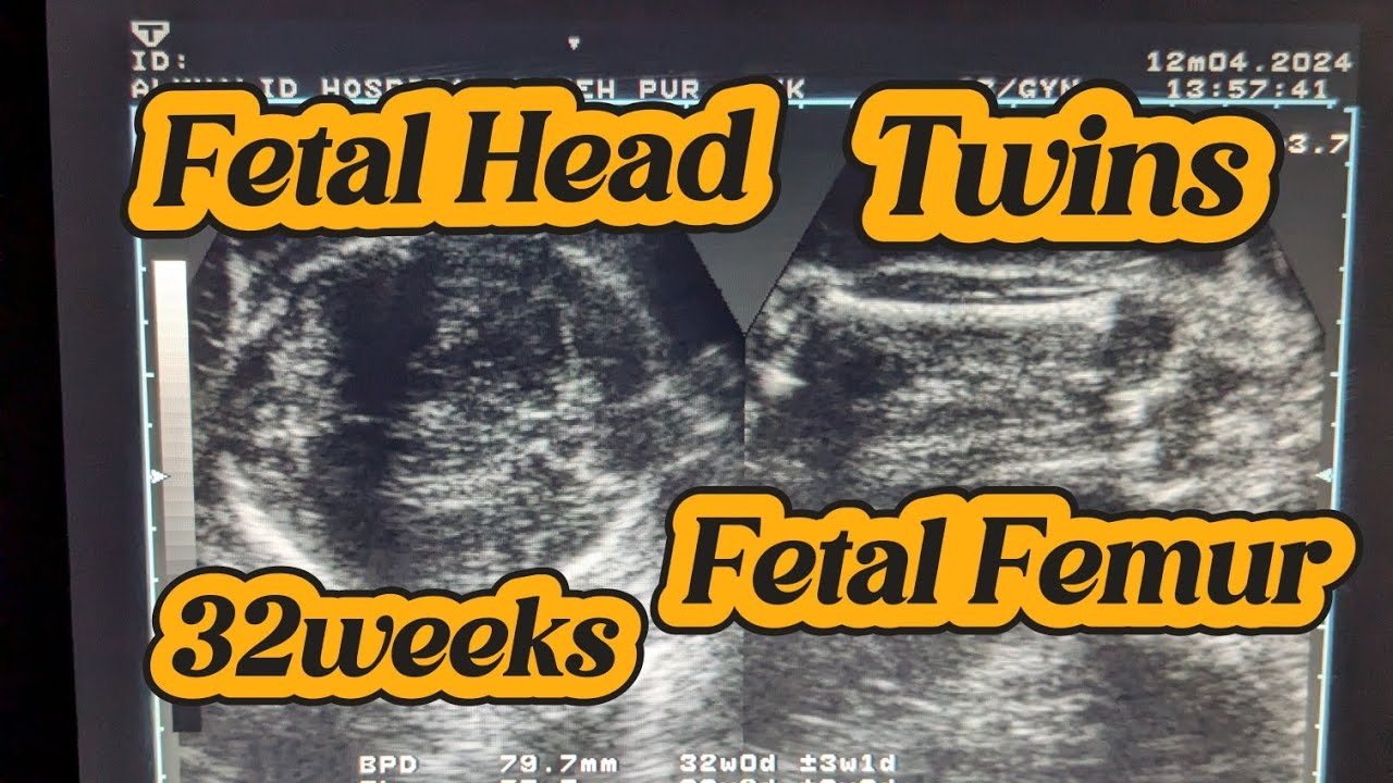 Twins Pregnancy | Ultrasound Twins | Anomaly Scan | Two Babies | Breech ...