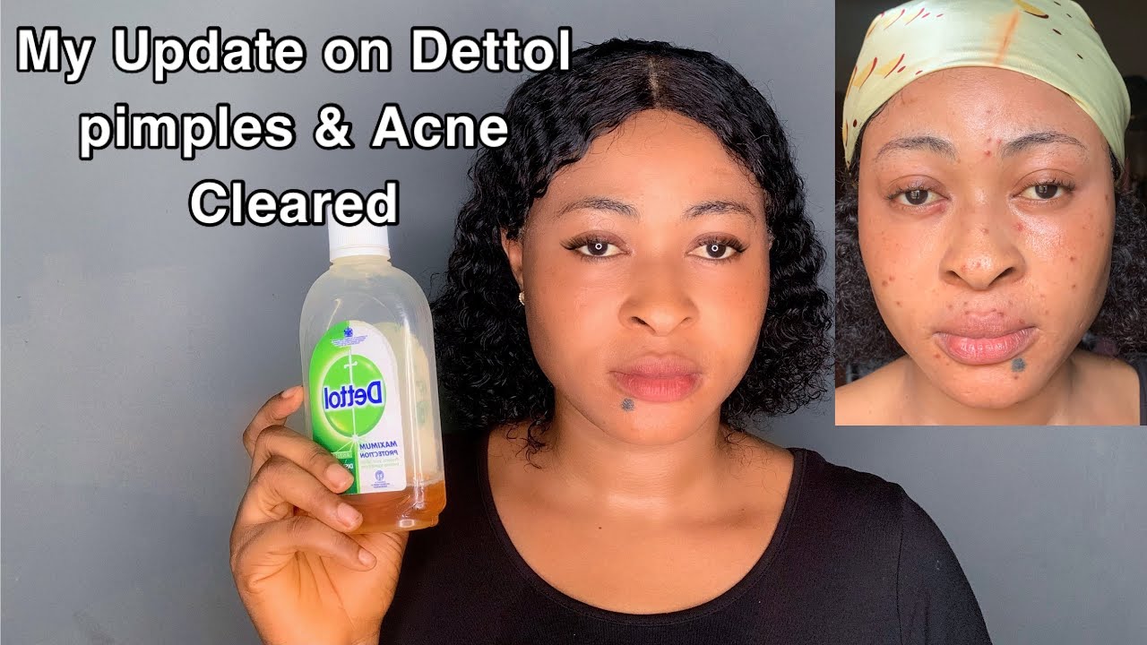 How I cleared my Pimples &Acne Using Dettol Antiseptic Liquid| Full ...
