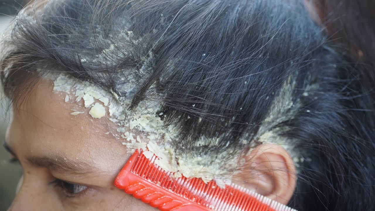 Full Scalp Inspection: Flakes Packed Into Every Line #542 - YouTube