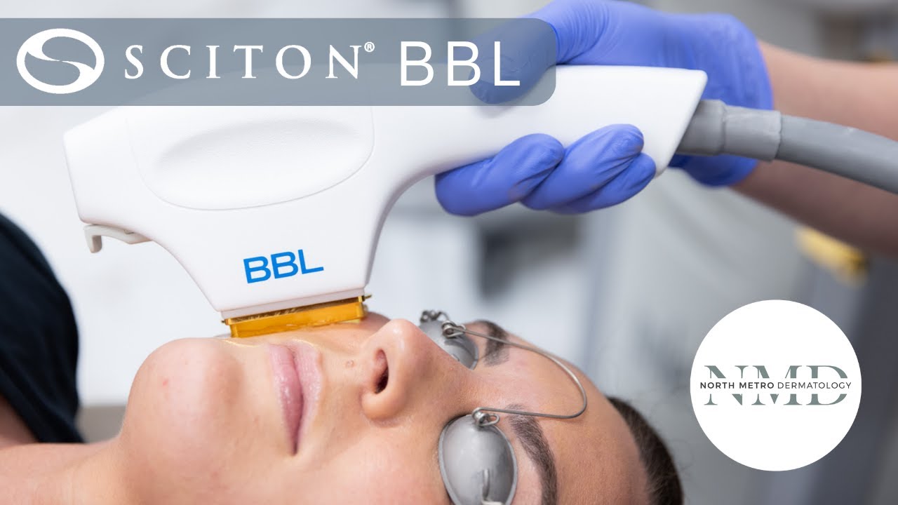 Sciton® BBL Treatment - YouTube