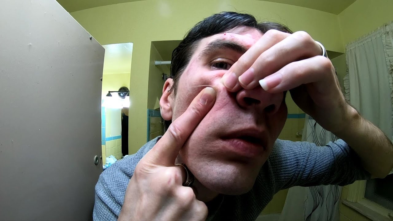 Popping Some Face Gremlins - YouTube