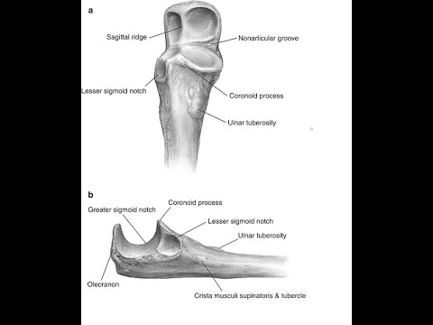 Olecranon Osteotomy Approach