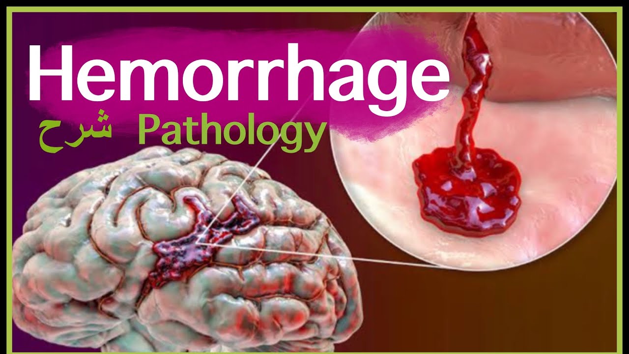 Pathology | Hemorrhage | Blood (Hemodynamic) disorders شرح باثو - YouTube