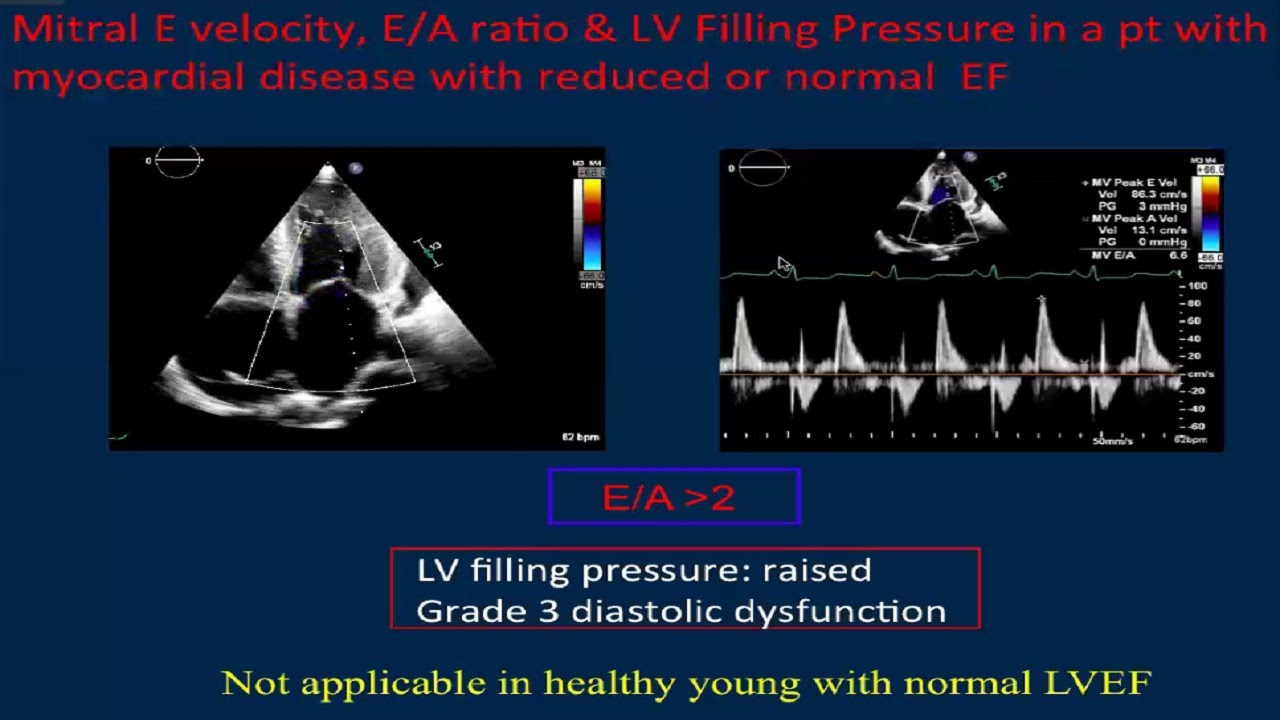 LV Systolic & Diastolic Function (Echo Assessment) by Dr. Debika ...