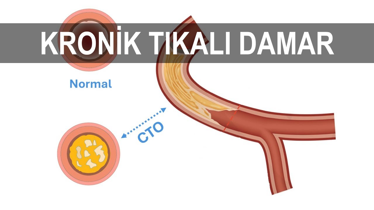 TAM TIKALI DAMAR (CTO) - YouTube