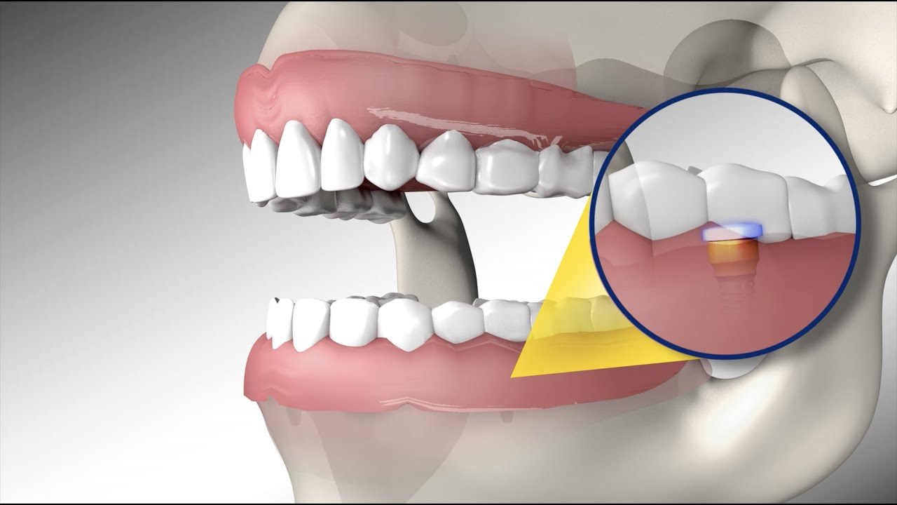 Locked In & Ready to Go | Renew Anchored Dentures - YouTube