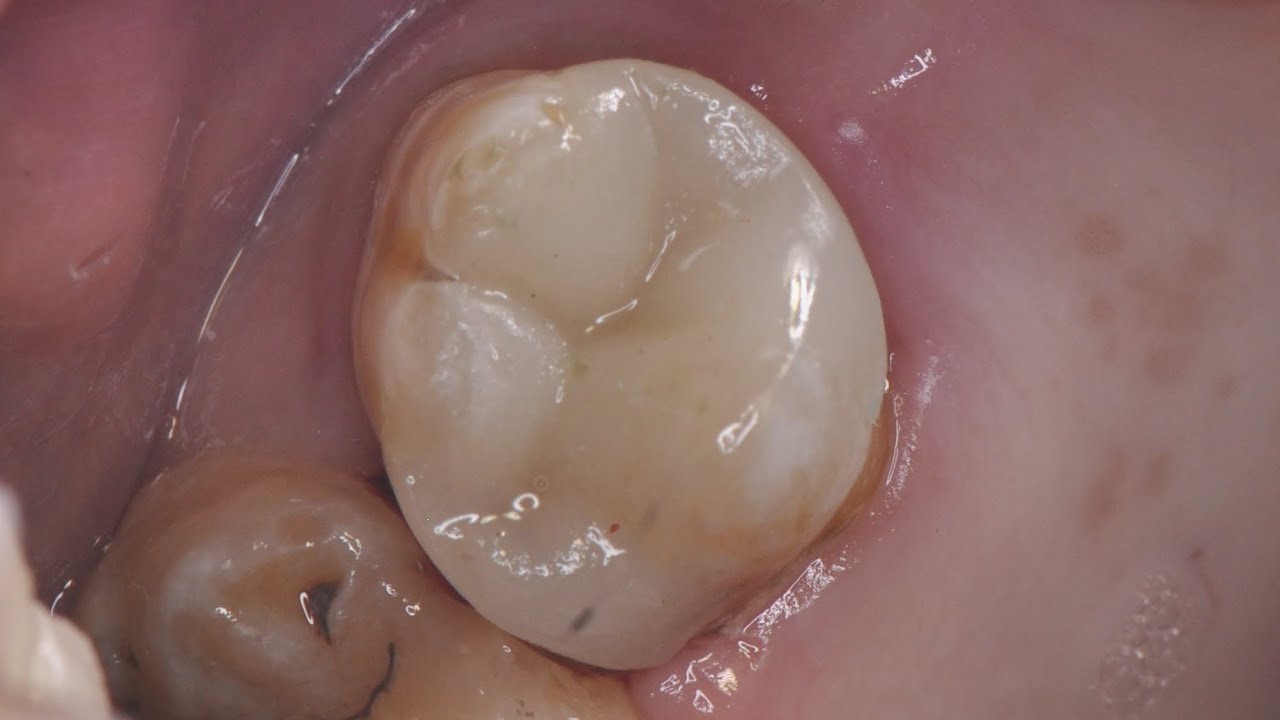 Root canal treatment and direct composite restoration on a 27 - YouTube