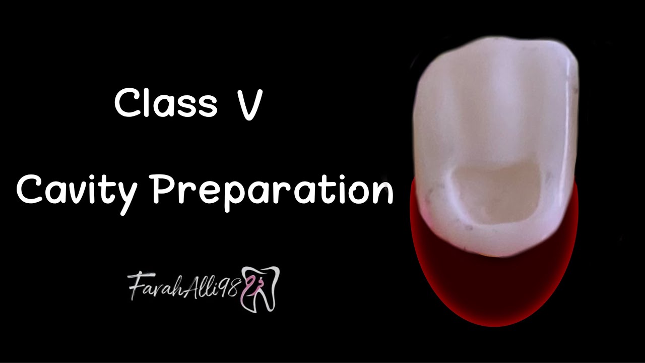Class 5 Cavity Preparation | فرح علي FarahAlli98 - YouTube