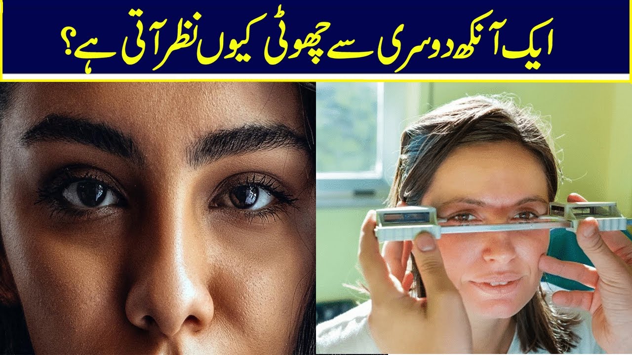 Why People Feel Their One Eye Is Smaller Than The Other? | #eyes - YouTube