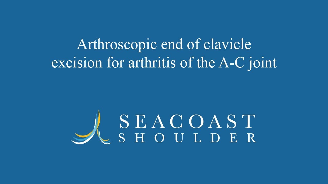 Arthroscopic end of clavicle excision for arthritis of the A-C joint ...