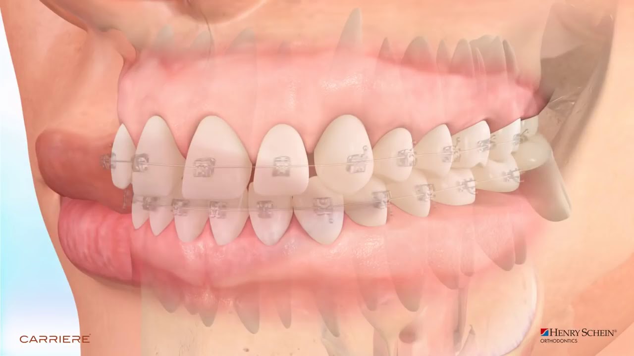 Class II Appliance Carriere Motion - YouTube