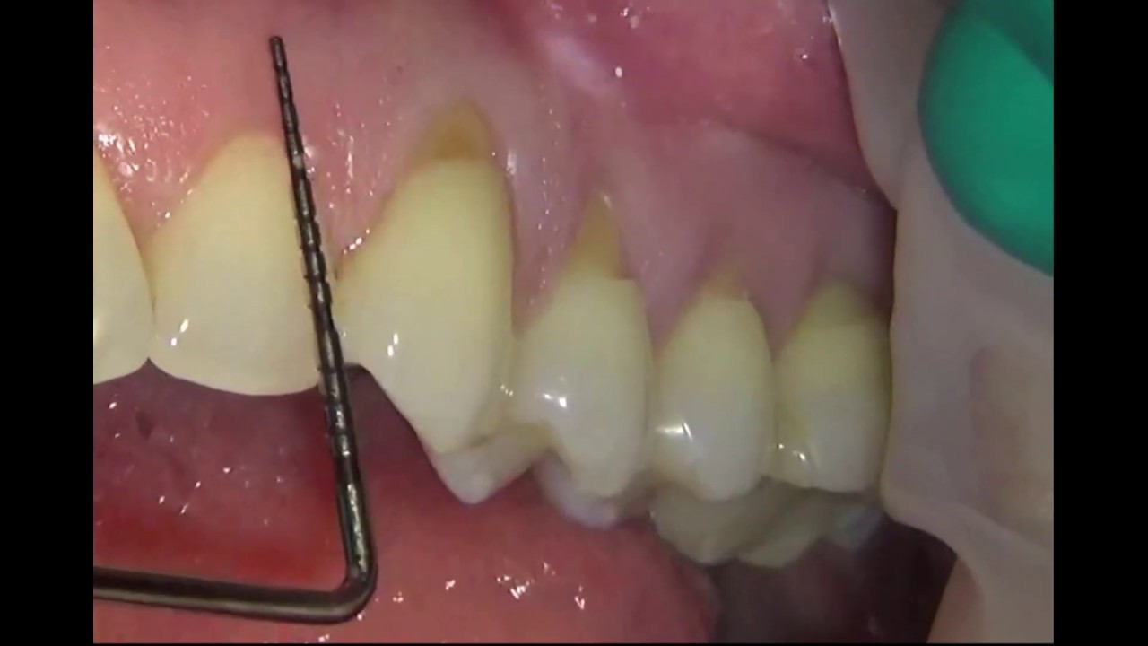 Periodontal Microsurgery: Connective Tissue Grafting - YouTube