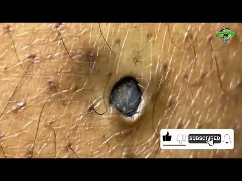 "Most Satisfying Huge Blackhead Removal, Skincare Transformation" - YouTube