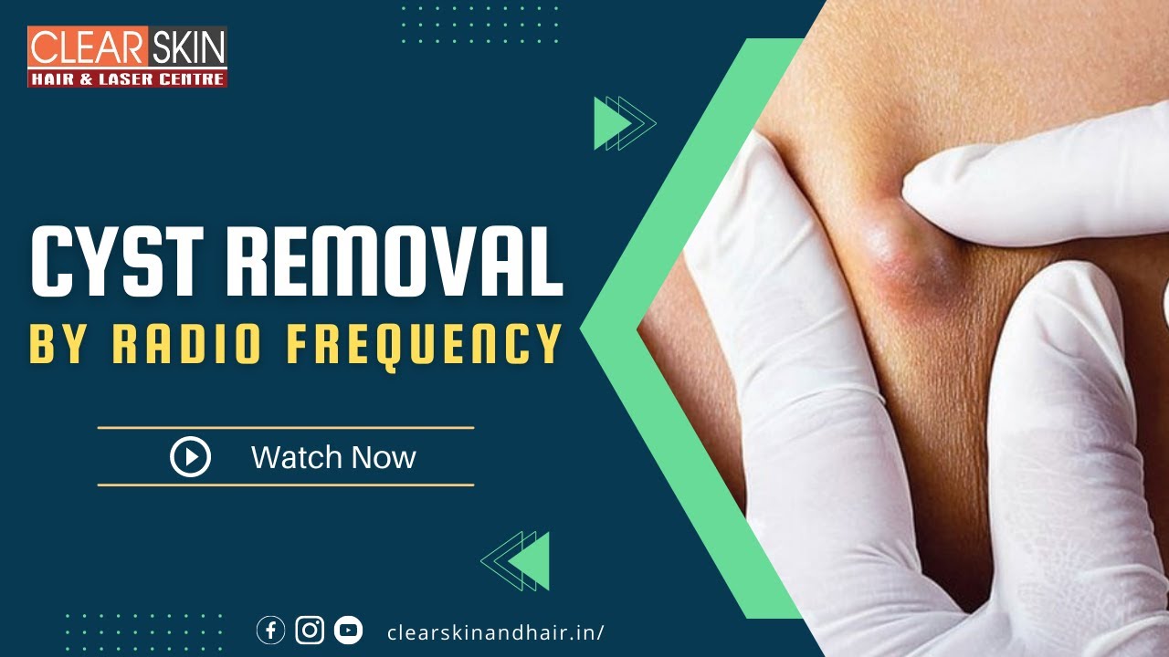 Cyst Removal by Radio Frequency || Best Laser Treatment for Cyst ...