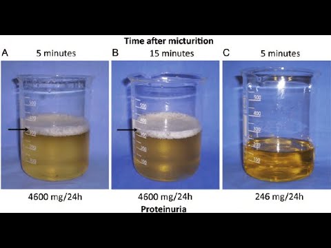Foamy or bubbly urine Or Frothy Urine ; Definition, Causes, Symptoms ...