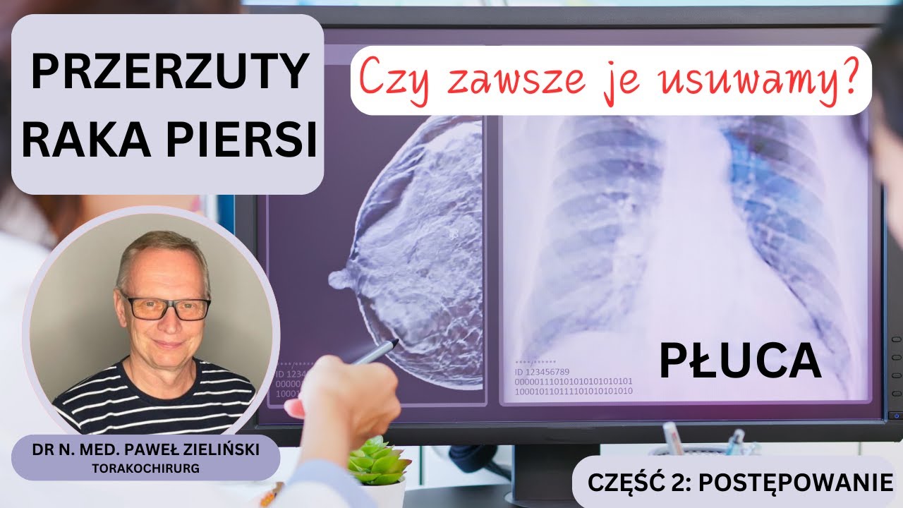 Odcinek 148. Czy zawsze usuwamy przerzuty raka piersi do płuc? - YouTube