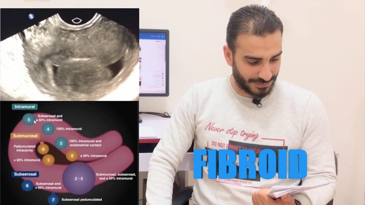 LEVEL 3 | FEMALE PELVIS | GYN | Myometrial lesions | Fibroid (Types ...