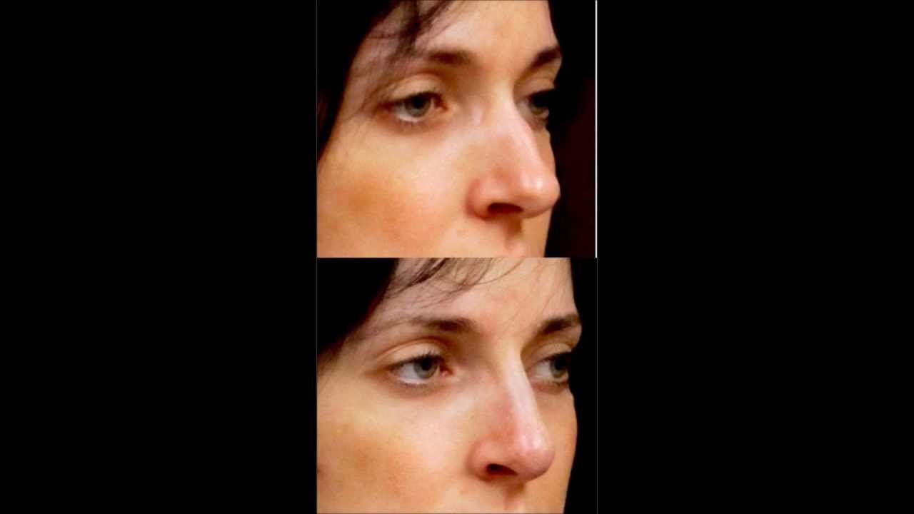 Eastern European Nose