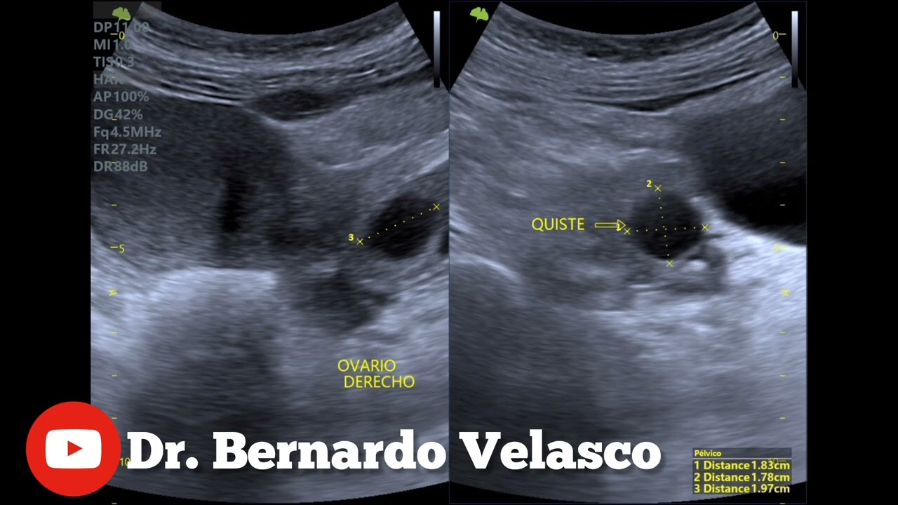 DOLOR ABDOMINAL POR QUISTE OVARICO DERECHO EN MUJER DE 33 AÑOS - YouTube
