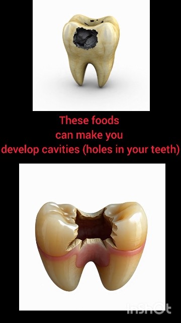 These foods can make you have holes (cavities) in your teeth #dentist # ...
