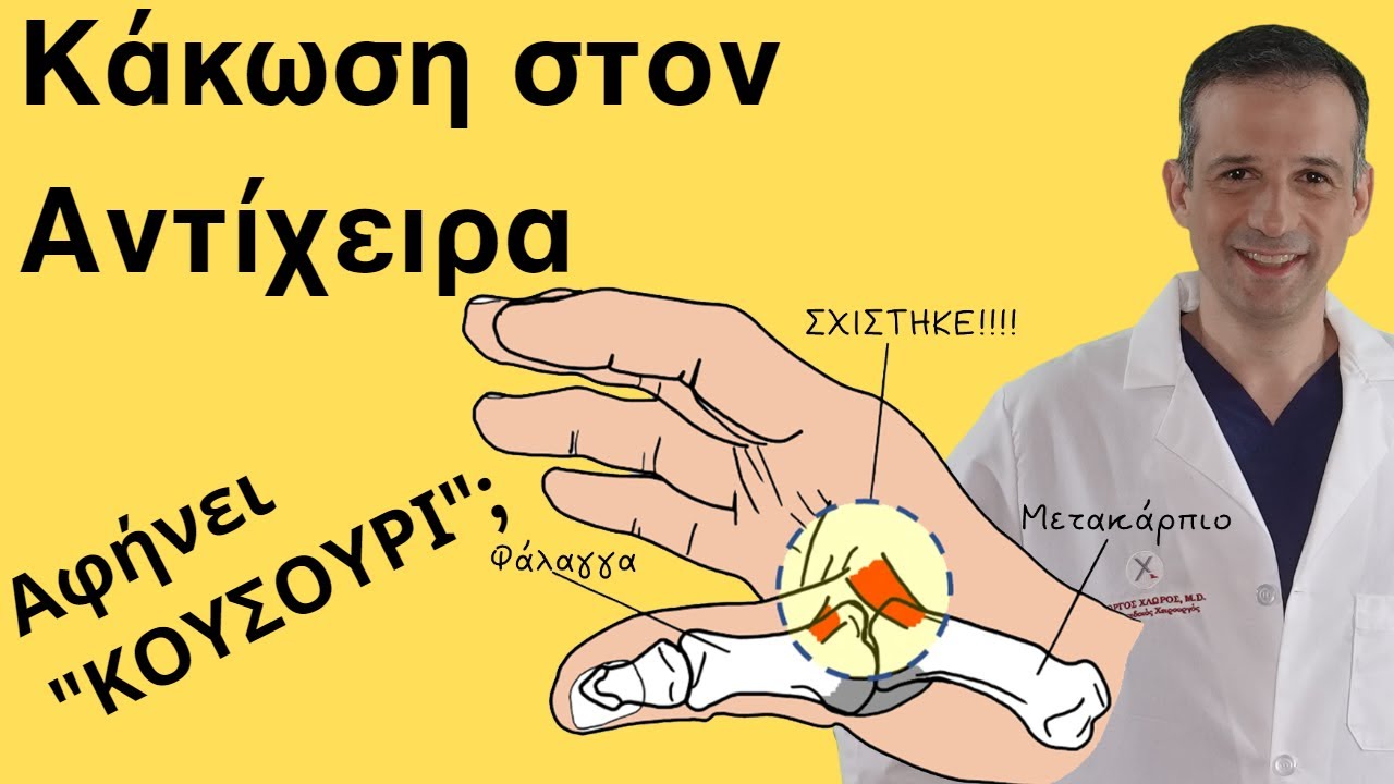 ΣΤΡΑΜΠΟΥΛΗΓΜΑ (κάκωση) Αντίχειρα: Είναι τόσο "αθώο"; #orthopaidikos ...
