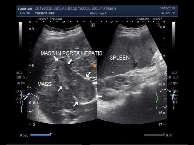 Porta Hepatis Lymph Node