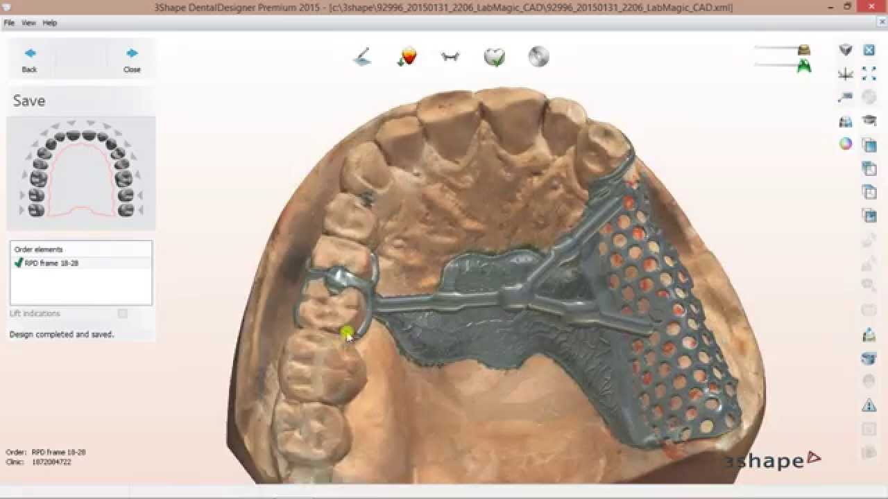 RPD Pre-manufacturing & Finalizing in 3Shape Dental System 2015 - YouTube