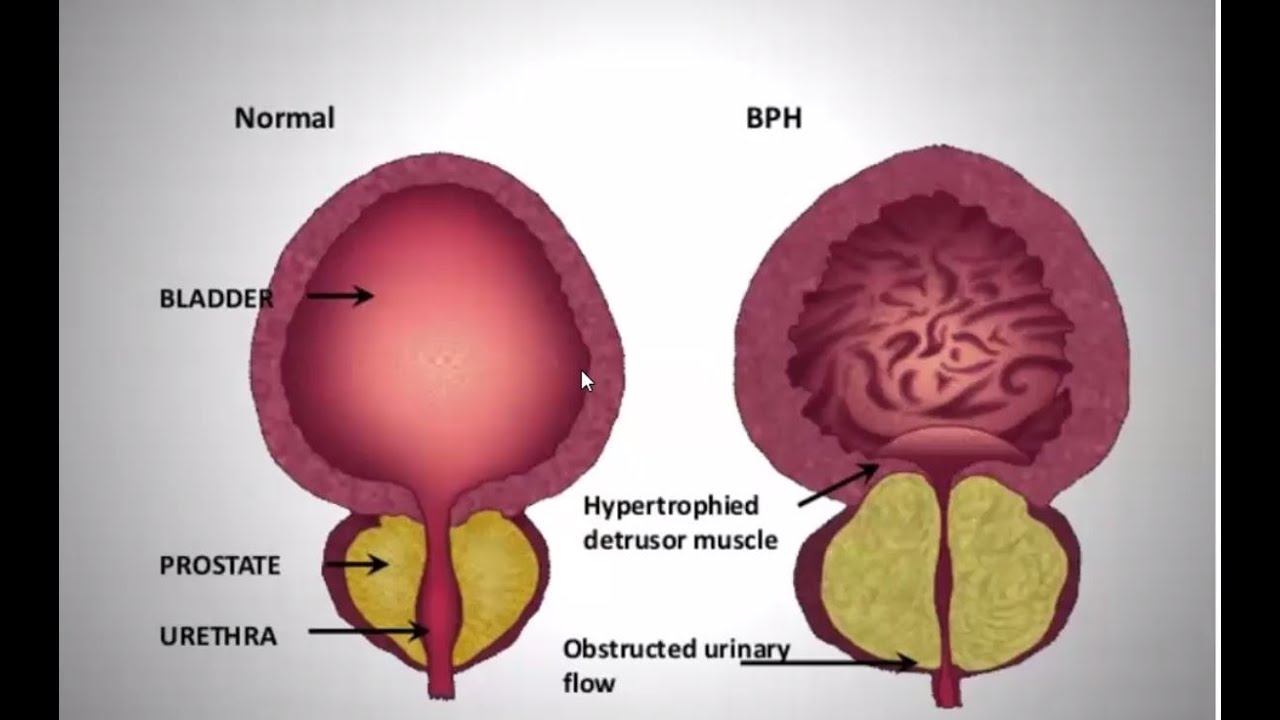 Management of Benign Prostatic Hyperplasia (BPH) | Carcinoma of ...