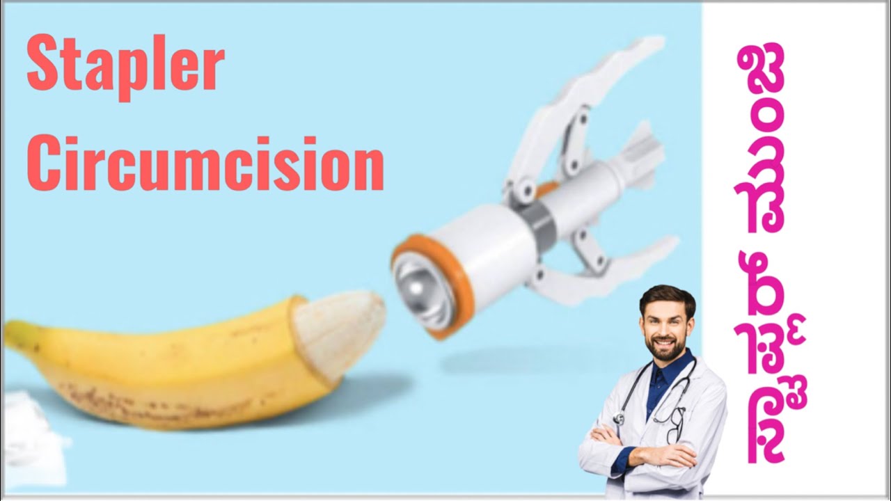 Live Surgery: Stapler Circumcision of Big Penis. ಸ್ಟಾಪ್ಲರ್ ಮುಂಜಿ. Dr C Sharath Kumar, Sexologist ...