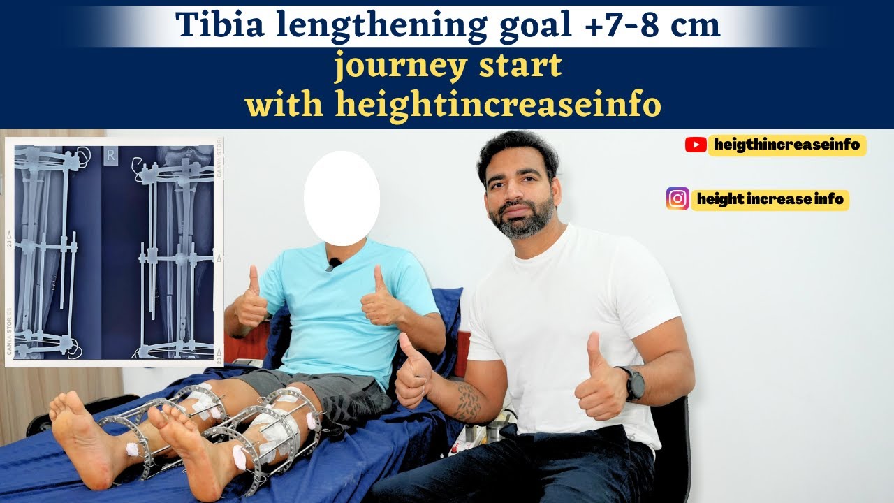 Tibia lengthening goal +7-8 cm journey start with #heightincreaseinfo - YouTube