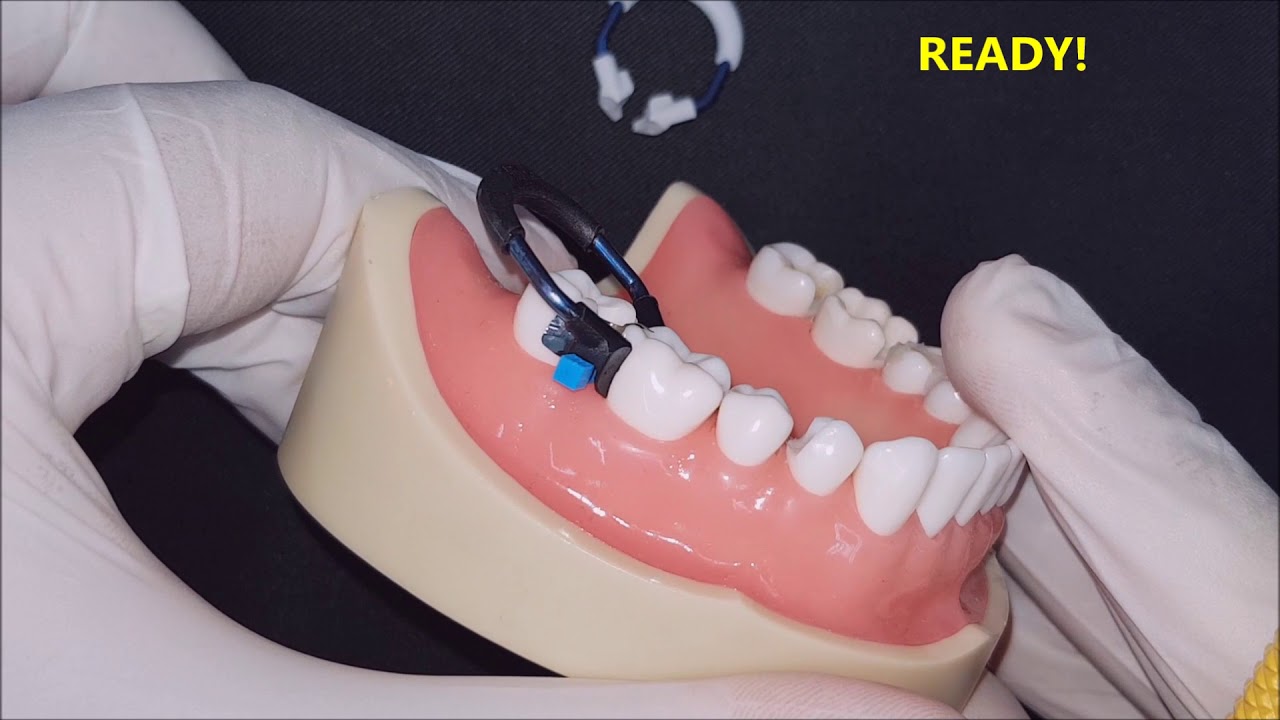 NiTin Sectional Matrix System, New, Improved Rings - YouTube
