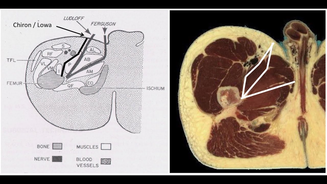 The minimal invasive medial approach of the hip by Philippe Chiron ...
