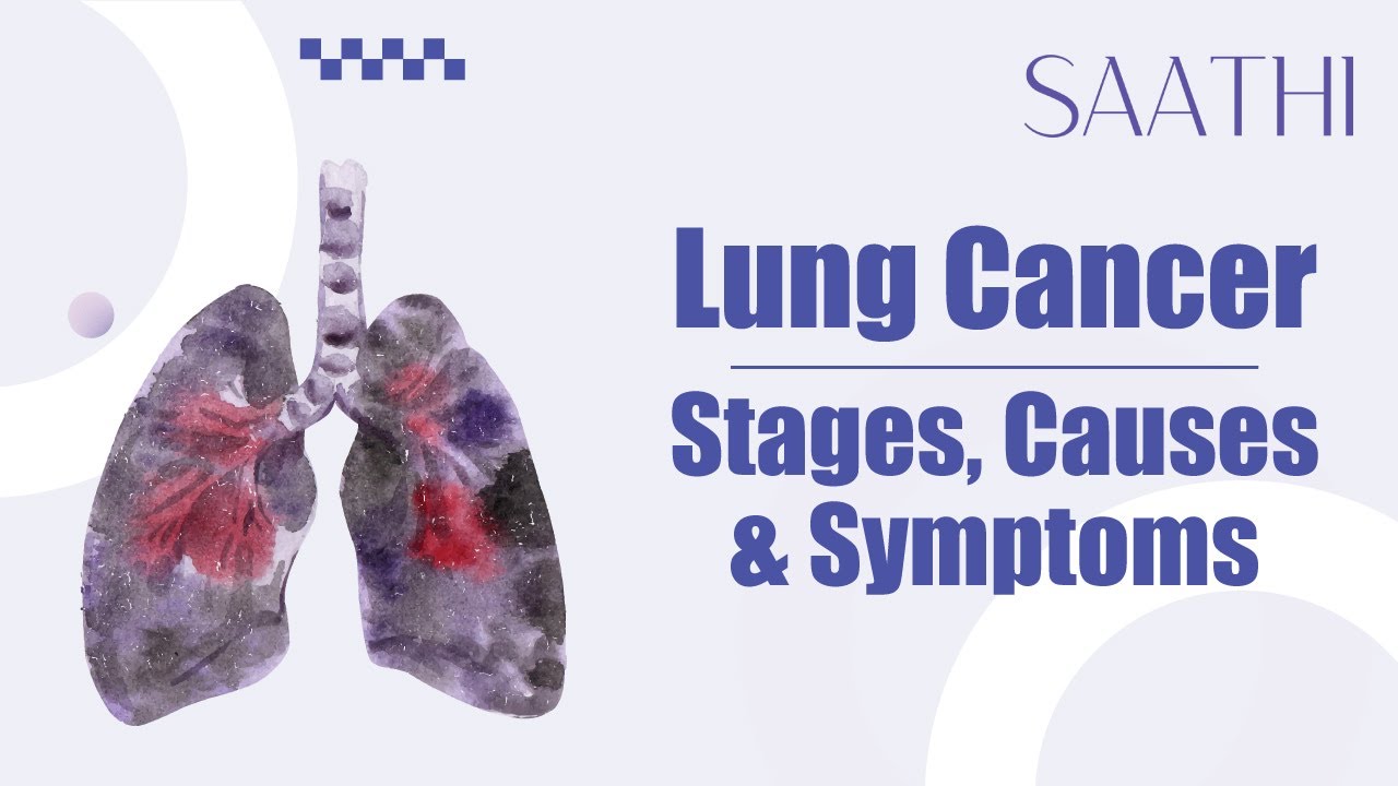 Lung Cancer Terminal Stage Symptoms – NOSXAT