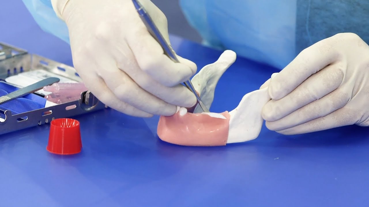 Placing OSSIX® Plus resorbable membrane Part 1 - YouTube