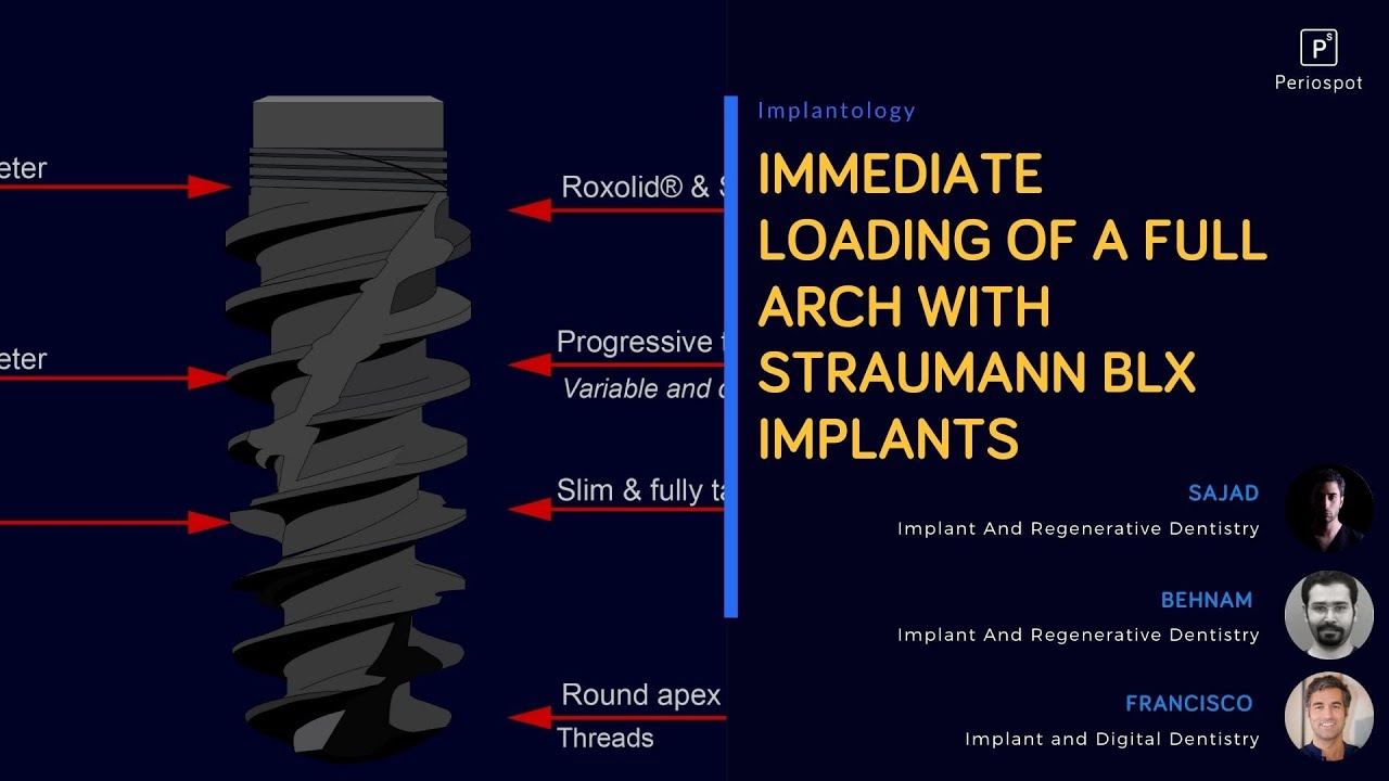 Full arch surgery with BLX implants and with immediate loading after ...