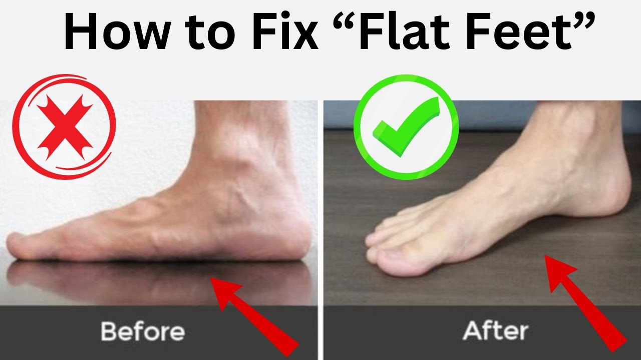 how to fix flat feet naturally - YouTube