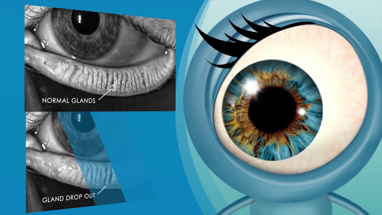 Dry Eye Disease and MGD - YouTube