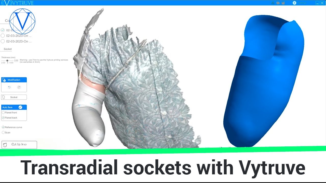 Transradial socket with VYTRUVE - YouTube