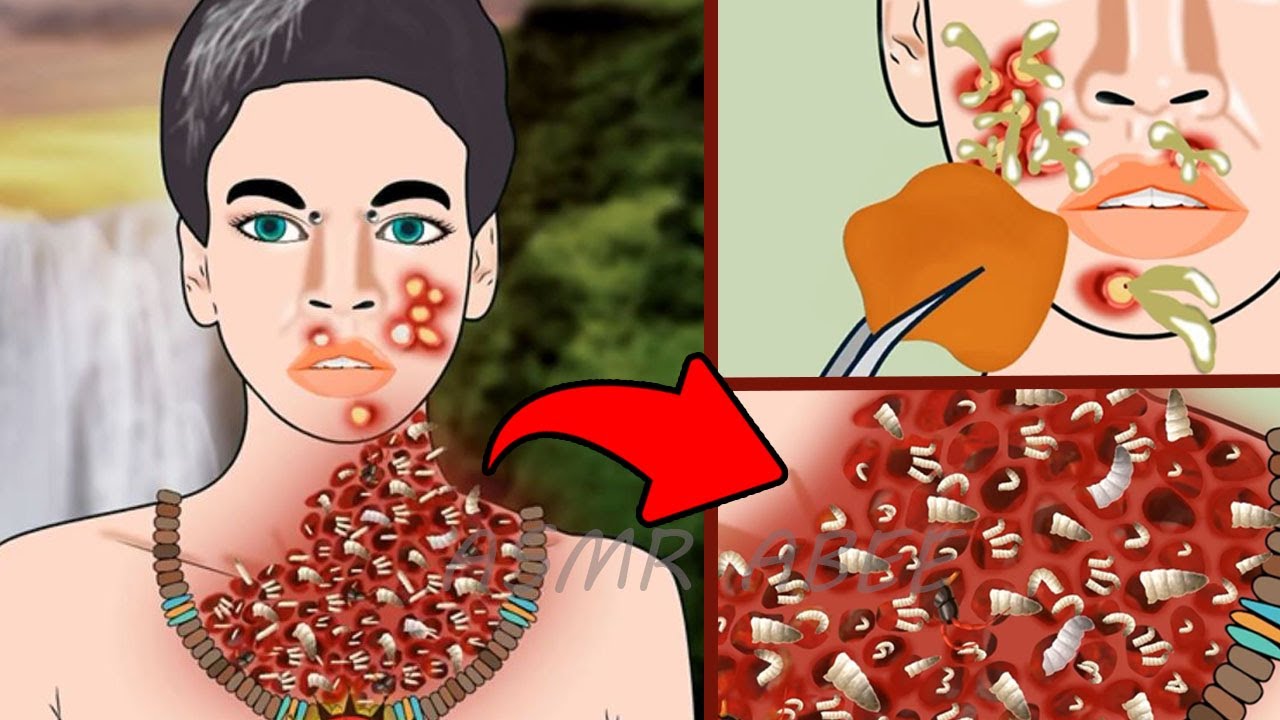ASMR Removal of Maggot Infected Face, Cleansing face full of maggots ...