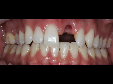 Front tooth extraction with immediate implant and temporary - YouTube
