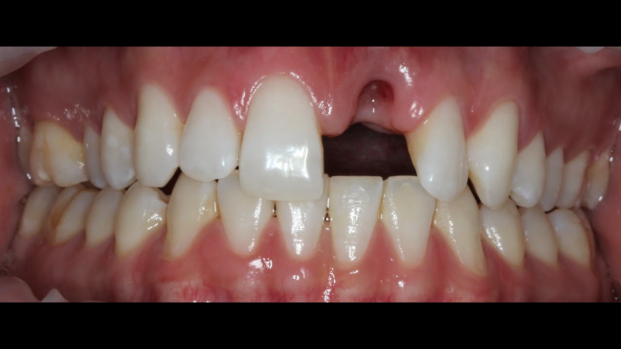 Front tooth extraction with immediate implant and temporary - YouTube