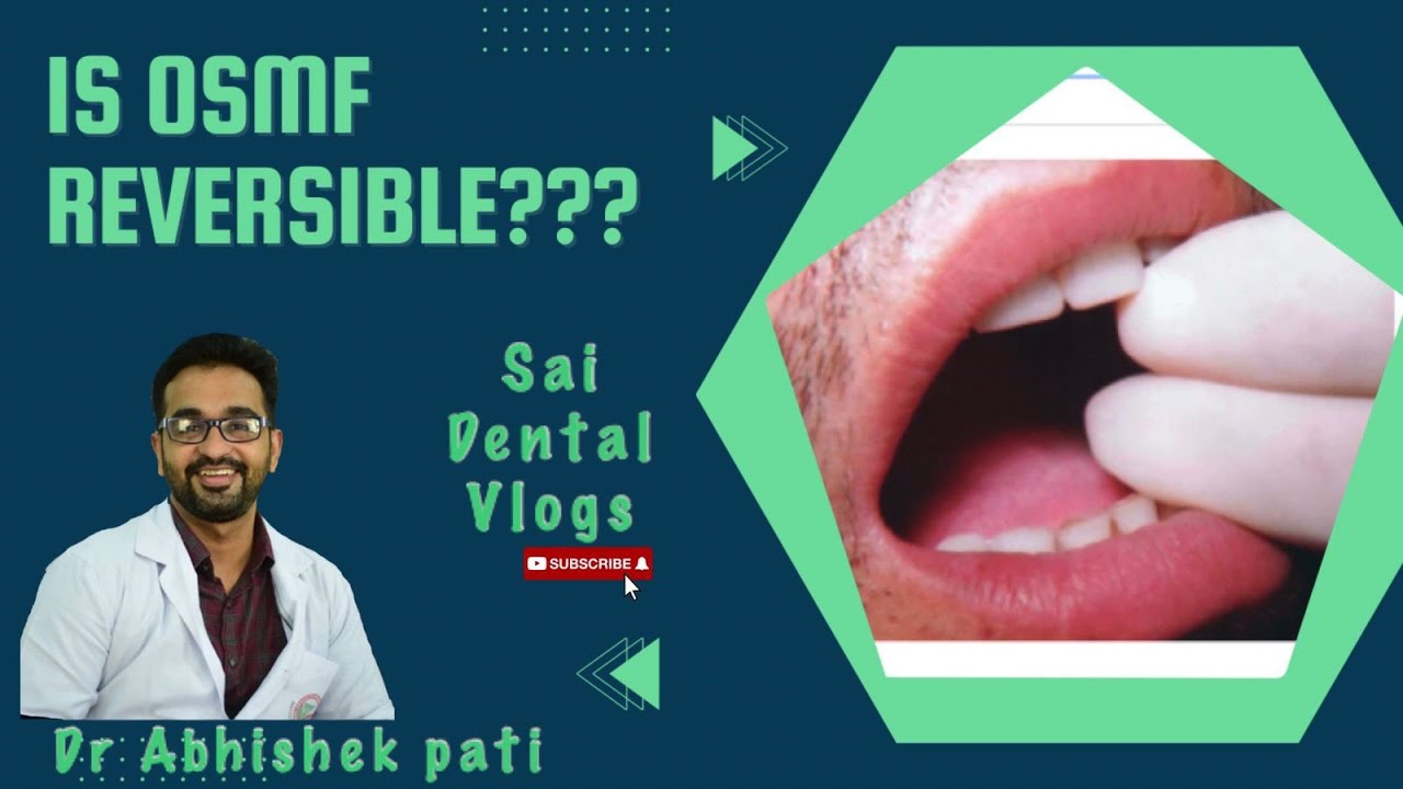 IS OSMF REVERSIBLE ? ( ORAL SUBMUCOUS FIBROSIS) - YouTube