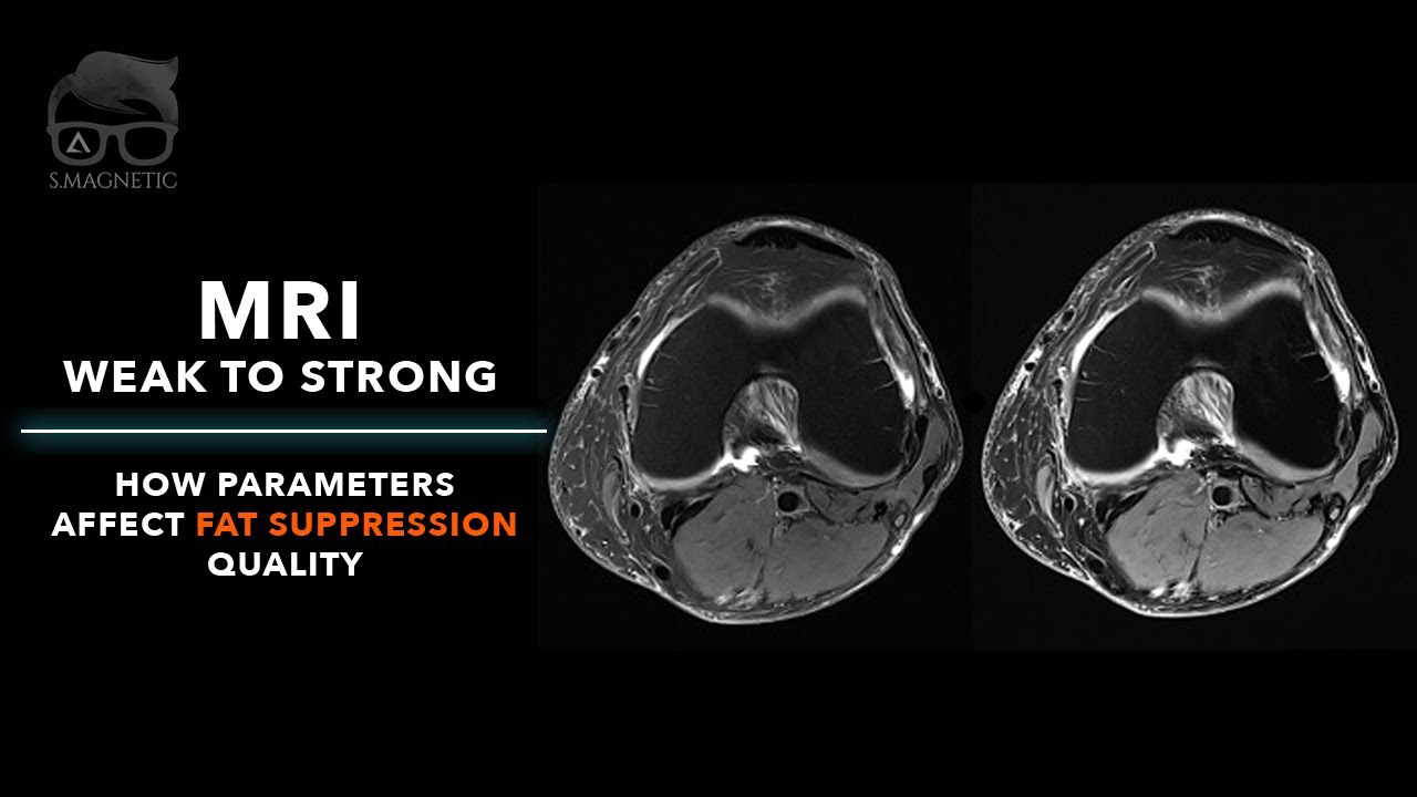MRI – WEAK TO STRONG : HOW PARAMETERS AFFECT FAT SUPPRESSION QUALITY ...