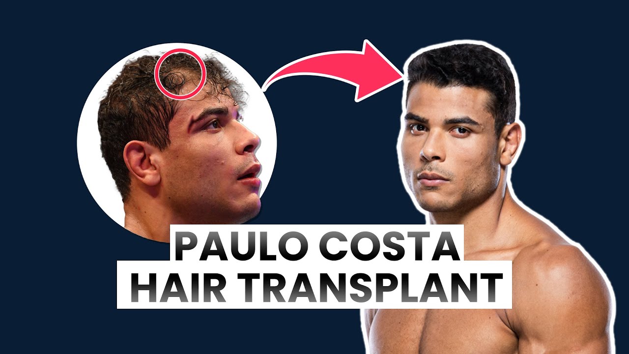 MMA FIGHTER Paulo Costa Hair Transplant - YouTube