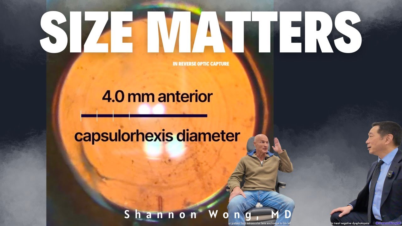Reverse optic capture for negative dysphotopsia w/a small anterior ...