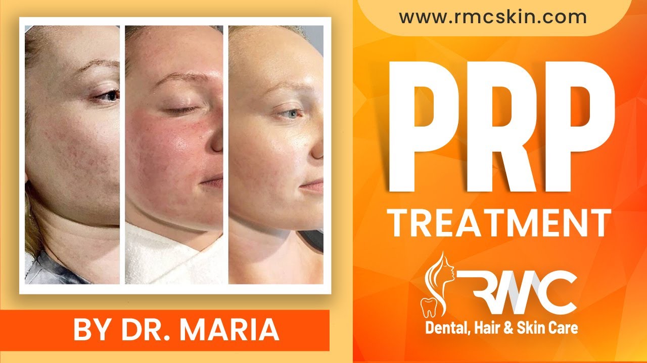 Revitalize Your Skin: Unveiling the Wonders of PRP Treatment with Dr ...